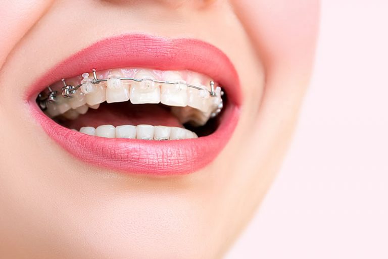 ¿Qué son los brackets transparentes? – Estudi Dental Barcelona
