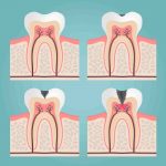 ¿Qué es la pulpitis irreversible? – Estudi Dental Barcelona