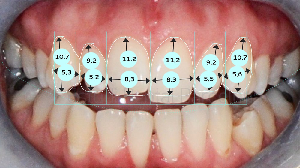 Dientes-de-diferentes-tamaÃ±os-corregidos-con-carillas-proporciones ...