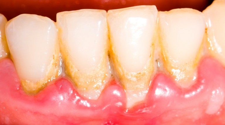¿Qué es el sarro dental y cuáles son sus consecuencias? – Estudi Dental ...