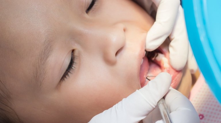 Avulsión dental, ¿qué es y cómo debemos actuar? – Estudi Dental Barcelona