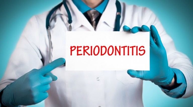 ¿Qué es la periodontitis agresiva? – Estudi Dental Barcelona