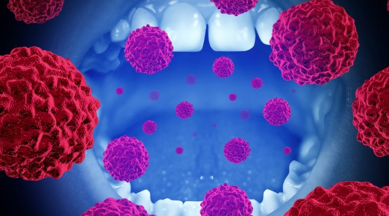 El cáncer bucal: signos y síntomas – Estudi Dental Barcelona