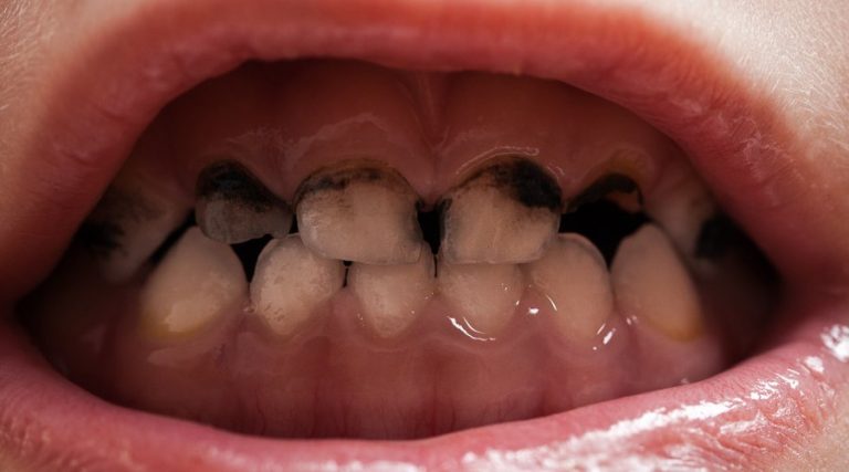 Caries infantil: qué la causa y cómo prevenirla – Estudi Dental Barcelona