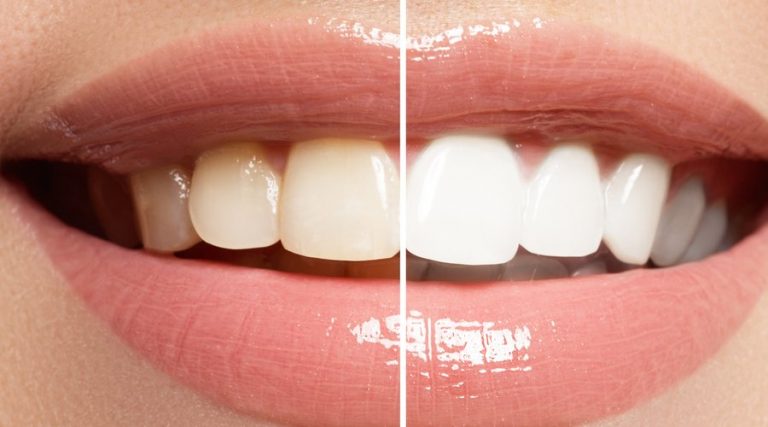 ¿De qué depende el color de los dientes? – Estudi Dental Barcelona