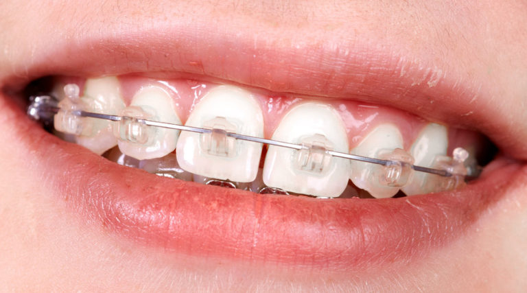 Tipos de arcos en la ortodoncia con brackets – Estudi Dental Barcelona