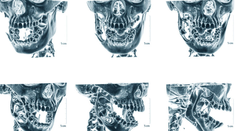 Mandíbula desencajada o dislocada: causas y tratamiento – Estudi Dental ...
