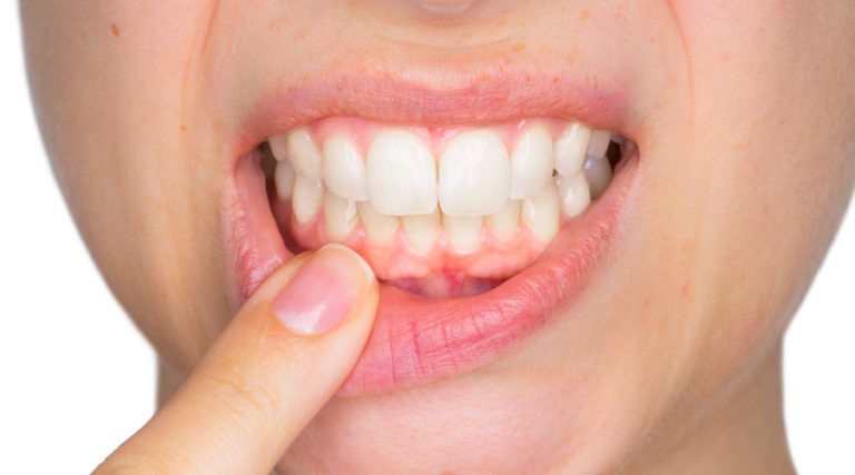 Tipos de encía y enfermedades relacionadas – Estudi Dental Barcelona